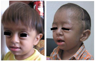 Case # 5 (Cranio ? facial cleft of Tessier)