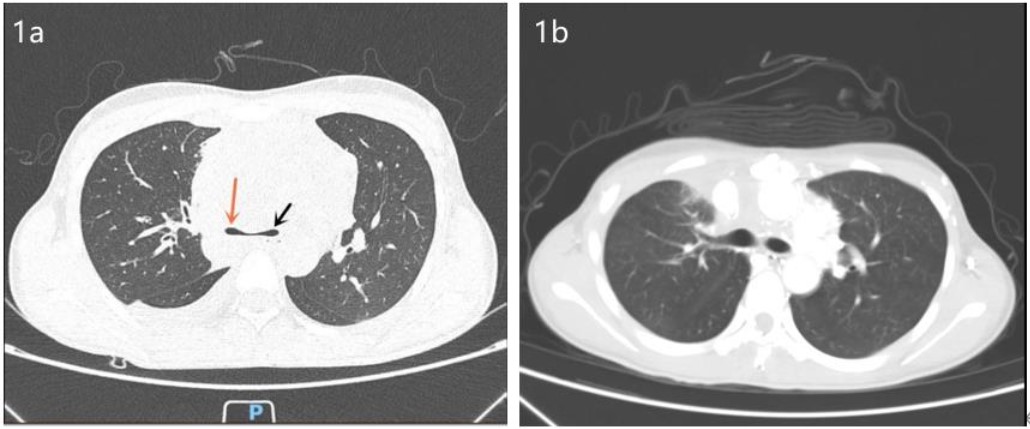 figure 1 the arrows showed that both the left and right main bronchi ...