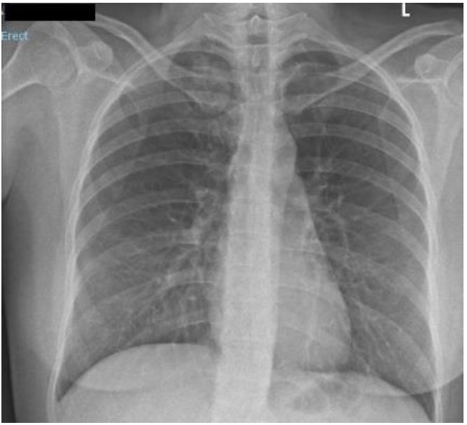 figure 1a cxr