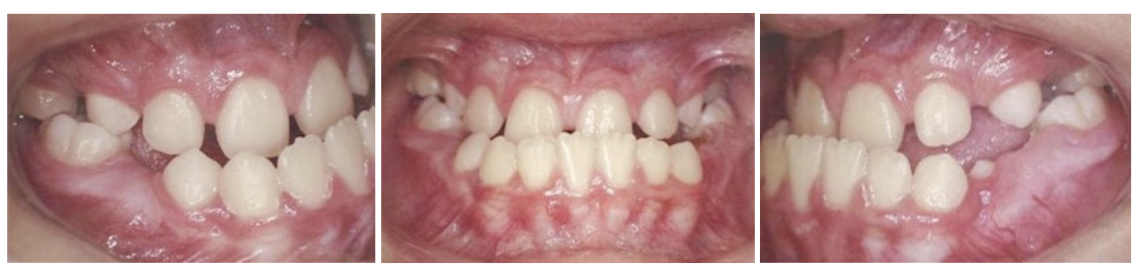 figure 2 pretreatment intraoral photographs show bilateral class iii