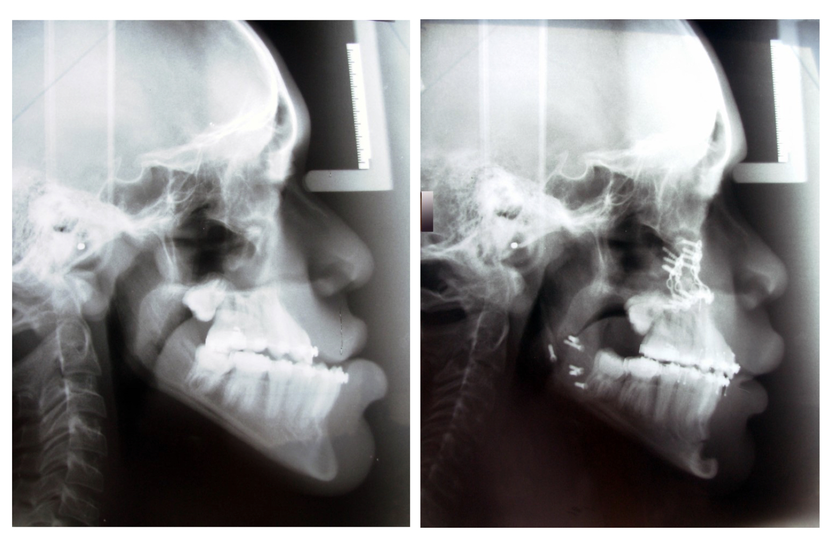 figure 8 a pre surgical cephalometric radiograph b post surgical ...