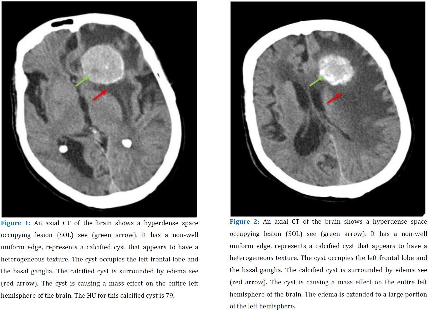 the cyst in the abdomen the patient refused to do the mri scan for the ...