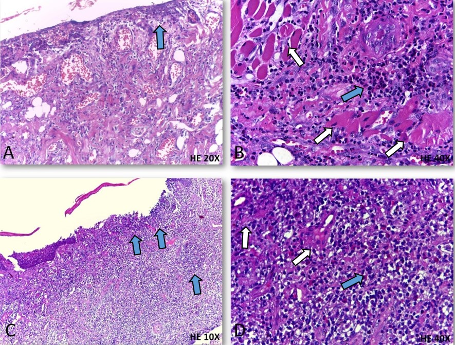 Traumatic Eosinophilic Granuloma