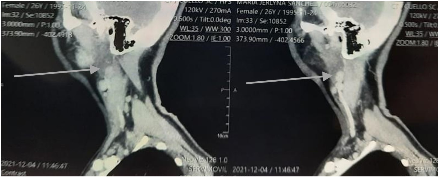 figure 2 contrast ct scan with contrast showing evidence of multiple ...