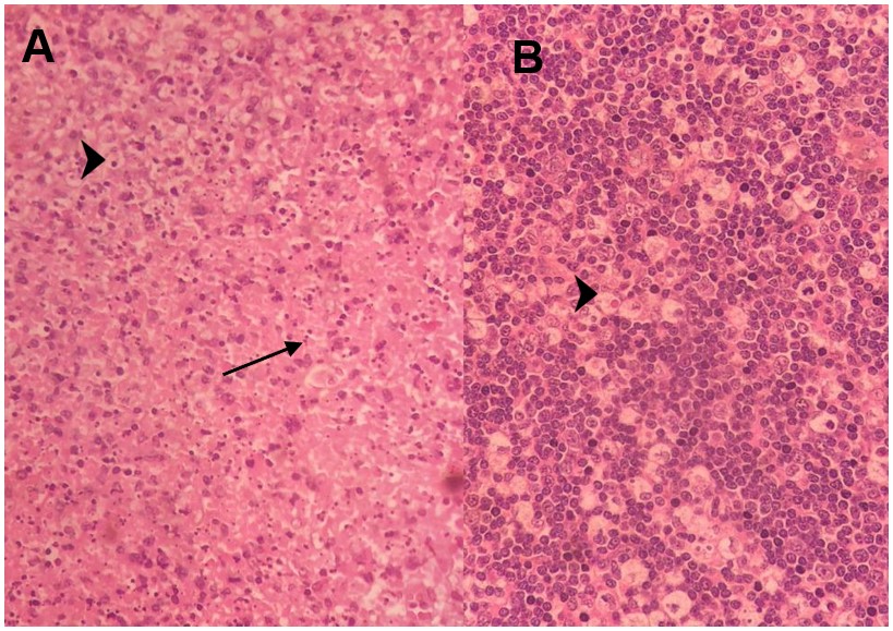 figure 4 a 10x granular eosinophilic material and abundant ...