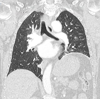 figure 1 ct scan december 2020 shows an elevated left hemi diaphragm