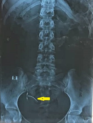 figure 1 a radiograph depicting the intrauterine contraceptive device ...
