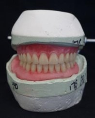 figure 4 prosthetic wax up for maxillary and mandibular arches