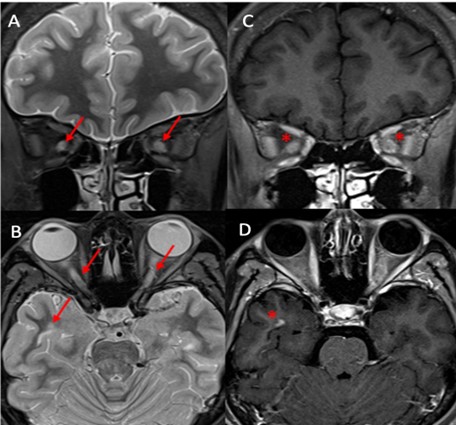 figure 2 repeat mri head and orbits coronal a and axial b short tau ...