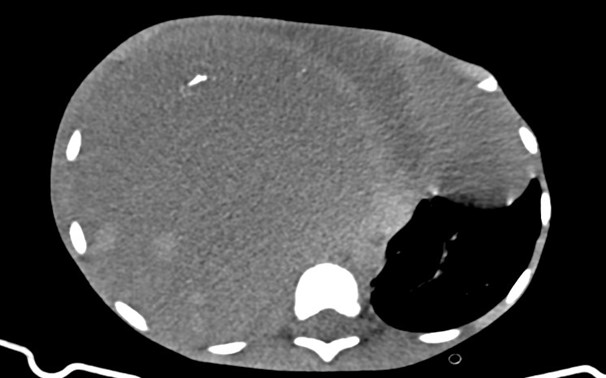 figure 1 axial section of pre contrast ct scan of the chest on soft ...