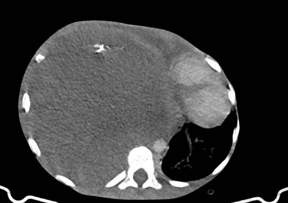 figure 3 axial section of post contrast ct scan of the chest on soft ...