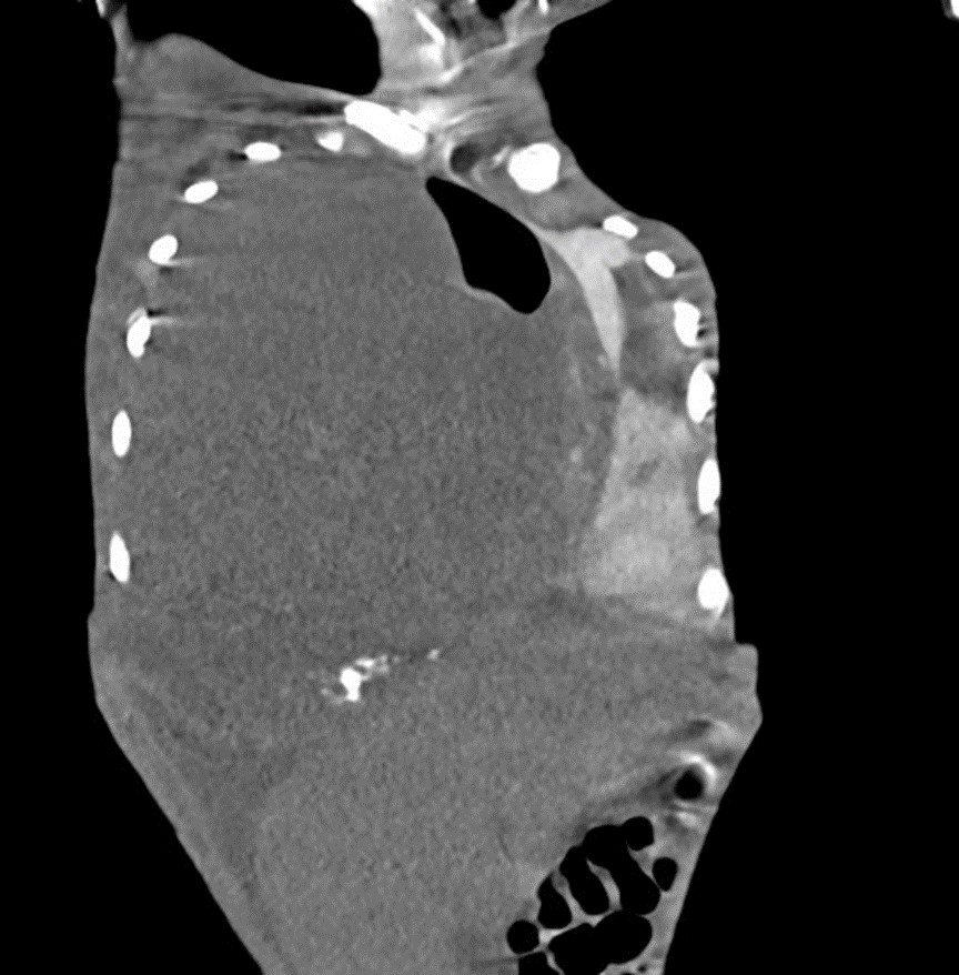figure 4 coronal section of post contrast ct scan of the chest on soft ...