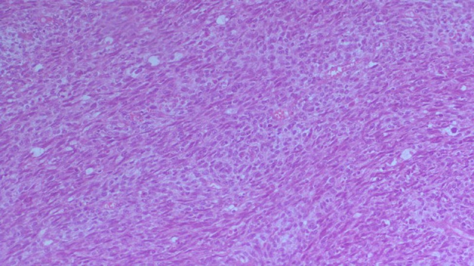 figure 7 10x magnification showing sheets of moderately to highly ...