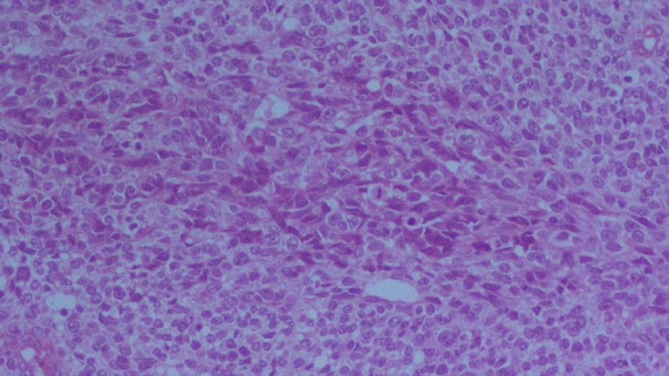 figure 8 higher magnification 40x showing areas of anaplasia with brisk ...