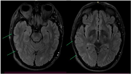 figure 1 brain magnetic resonance imaging mri showed hyperintense ...