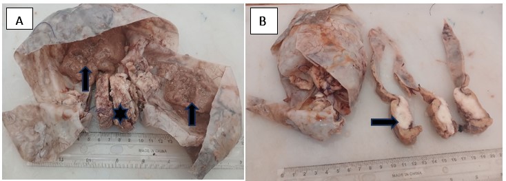 figure 1 gross pathologic photographic image a showing unilocular cyst ...