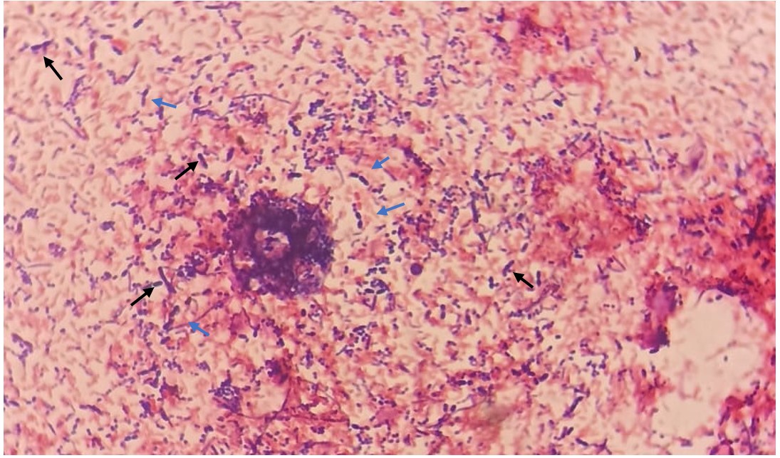 figure 2 gram stain of patient stool 1000x magnification showing a gram ...