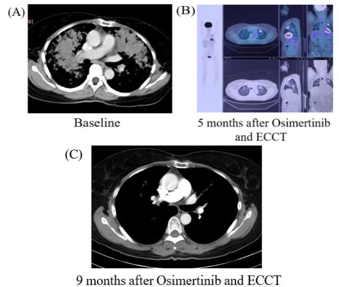 figure 5 case 5 baseline ct a 5 month b and 9 month c scans showing ...